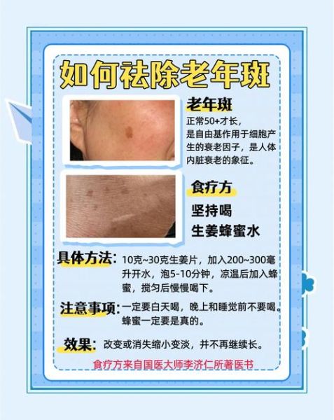 老年斑怎么去除最有效_老年斑消除最好的方法-第1张图片-山城妙识 老年斑怎么去除最有效_老年斑消除最好的方法-第1张图片-山城妙识
