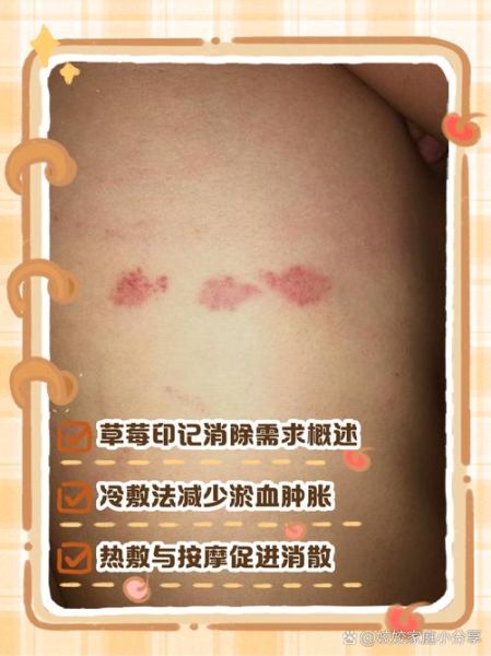 草莓印几天可以消除_如何快速淡化吻痕-第1张图片-山城妙识 草莓印几天可以消除_如何快速淡化吻痕-第1张图片-山城妙识