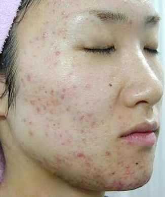 内分泌失调长痘吃什么药_如何调理见效快-第3张图片-山城妙识 内分泌失调长痘吃什么药_如何调理见效快-第3张图片-山城妙识