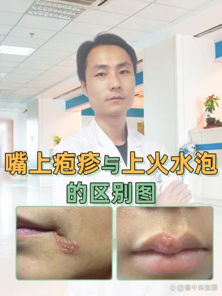 嘴唇上火起泡怎么快速消除_小妙招-第2张图片-山城妙识 嘴唇上火起泡怎么快速消除_小妙招-第2张图片-山城妙识
