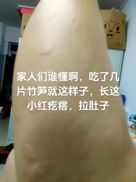 竹笋中毒的症状_怎么处理-第1张图片-山城妙识 竹笋中毒的症状_怎么处理-第1张图片-山城妙识