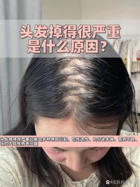 头发掉得很严重怎么办_头发掉得很严重是什么原因-第2张图片-山城妙识