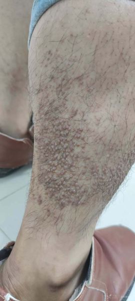 淀粉样变是什么病_淀粉样变能活多久-第1张图片-山城妙识