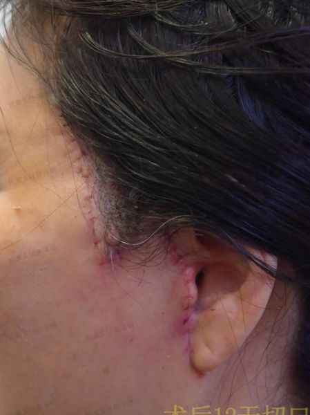 拉皮手术失败图片_如何避免拉皮失败-第3张图片-山城妙识 拉皮手术失败图片_如何避免拉皮失败-第3张图片-山城妙识