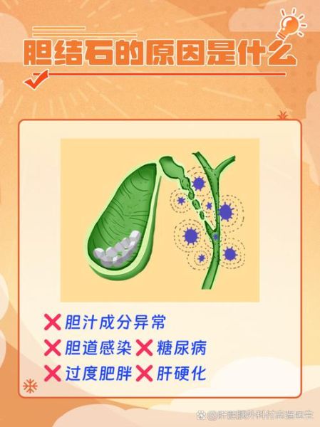 胆结石是怎么形成的_胆结石形成的原因有哪些-第1张图片-山城妙识